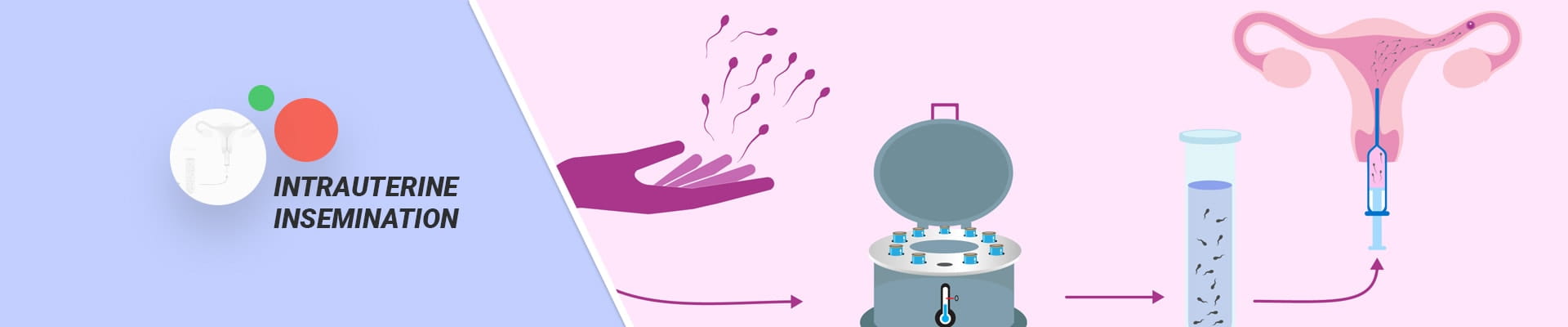 Intrauterine Insemination(IUI) - Newlife Fertility Centre | Siliguri